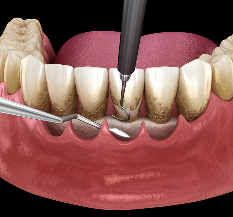 Periodontal Disease Treatment | Austin, TX