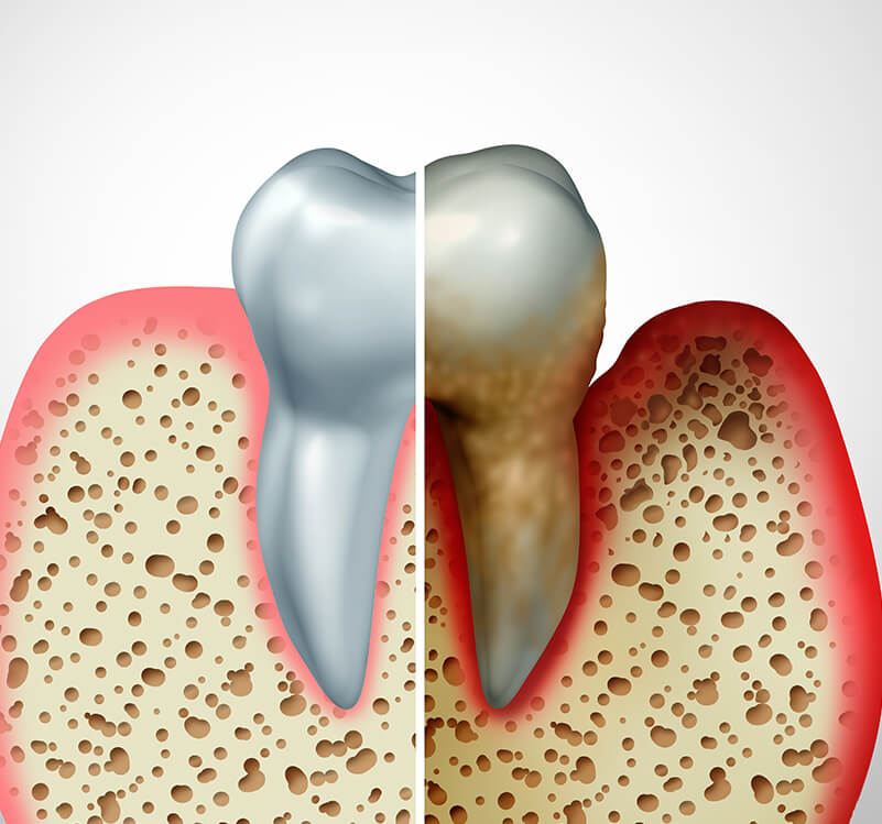 Periodontal Disease Treatment | Austin, TX